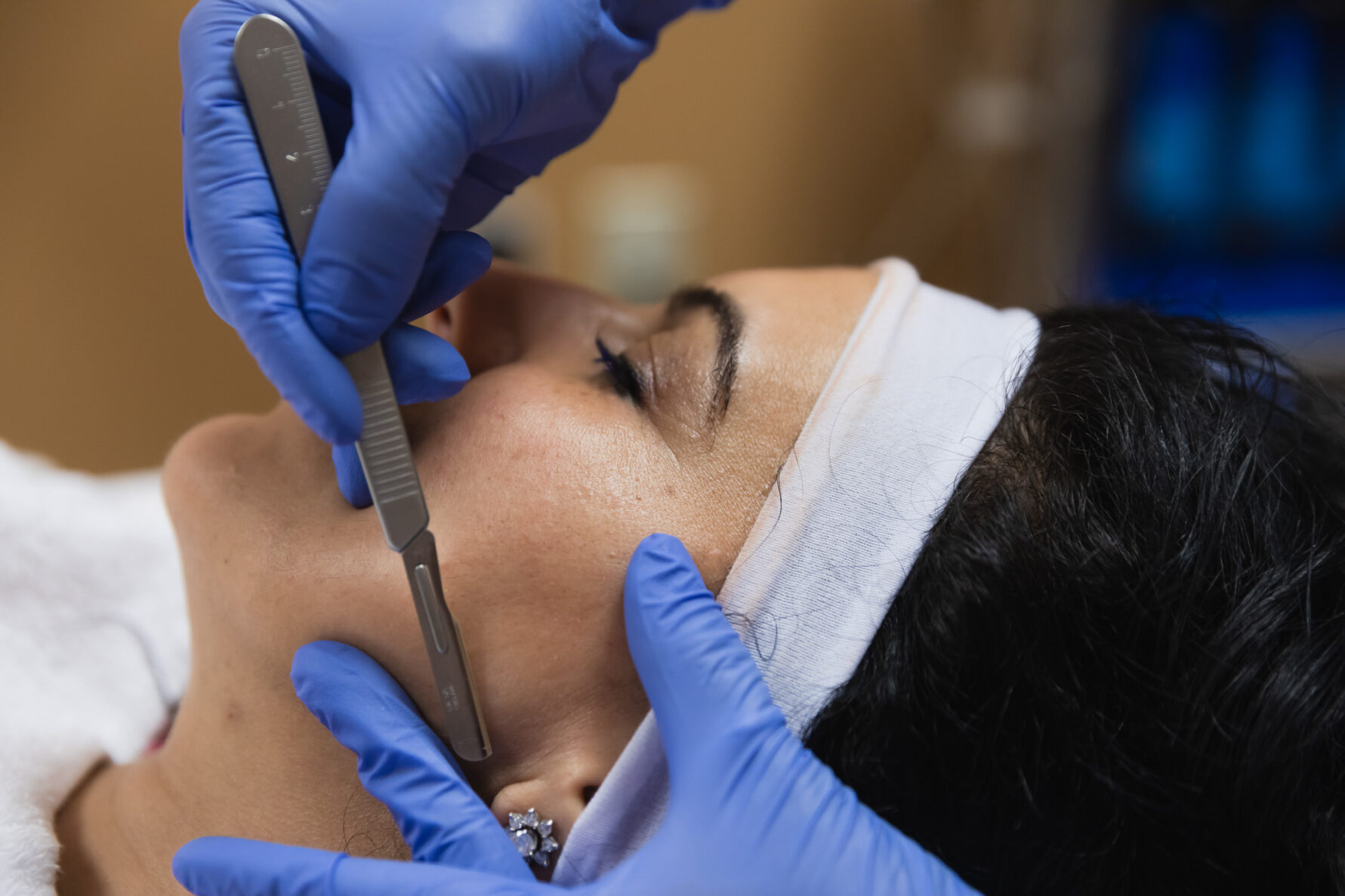 Dermaplaning in Winchester | Blossom Medical