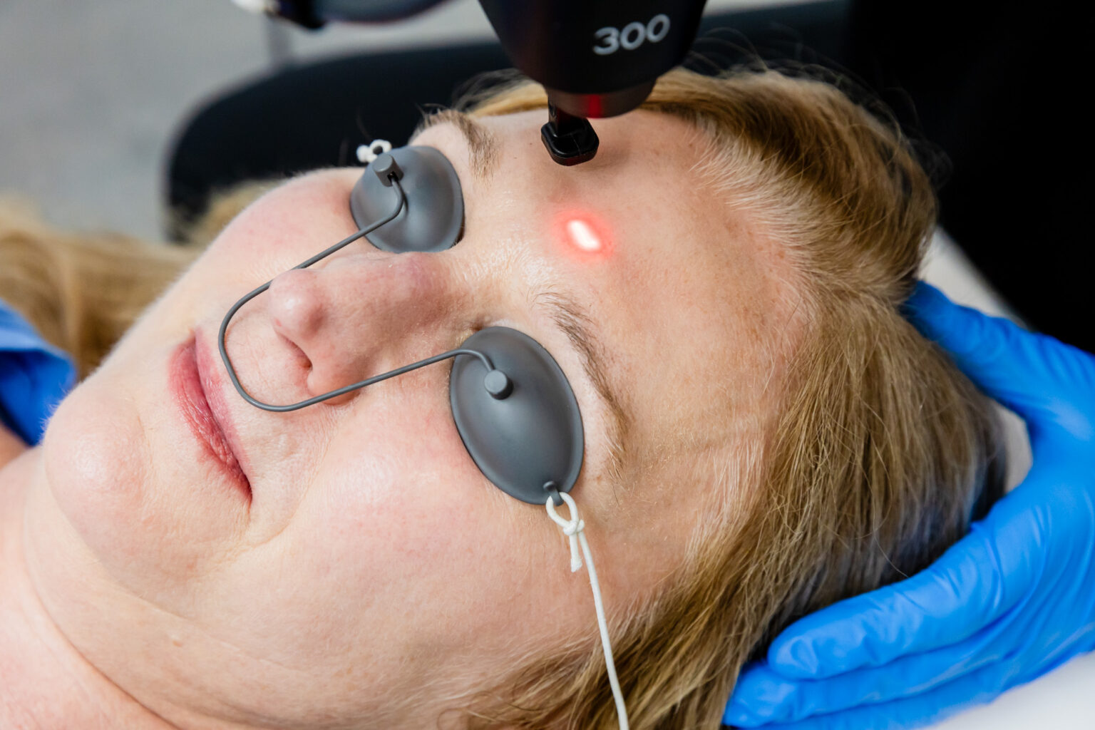 CO2 Laser Resurfacing in Winchester | Blossom Medical