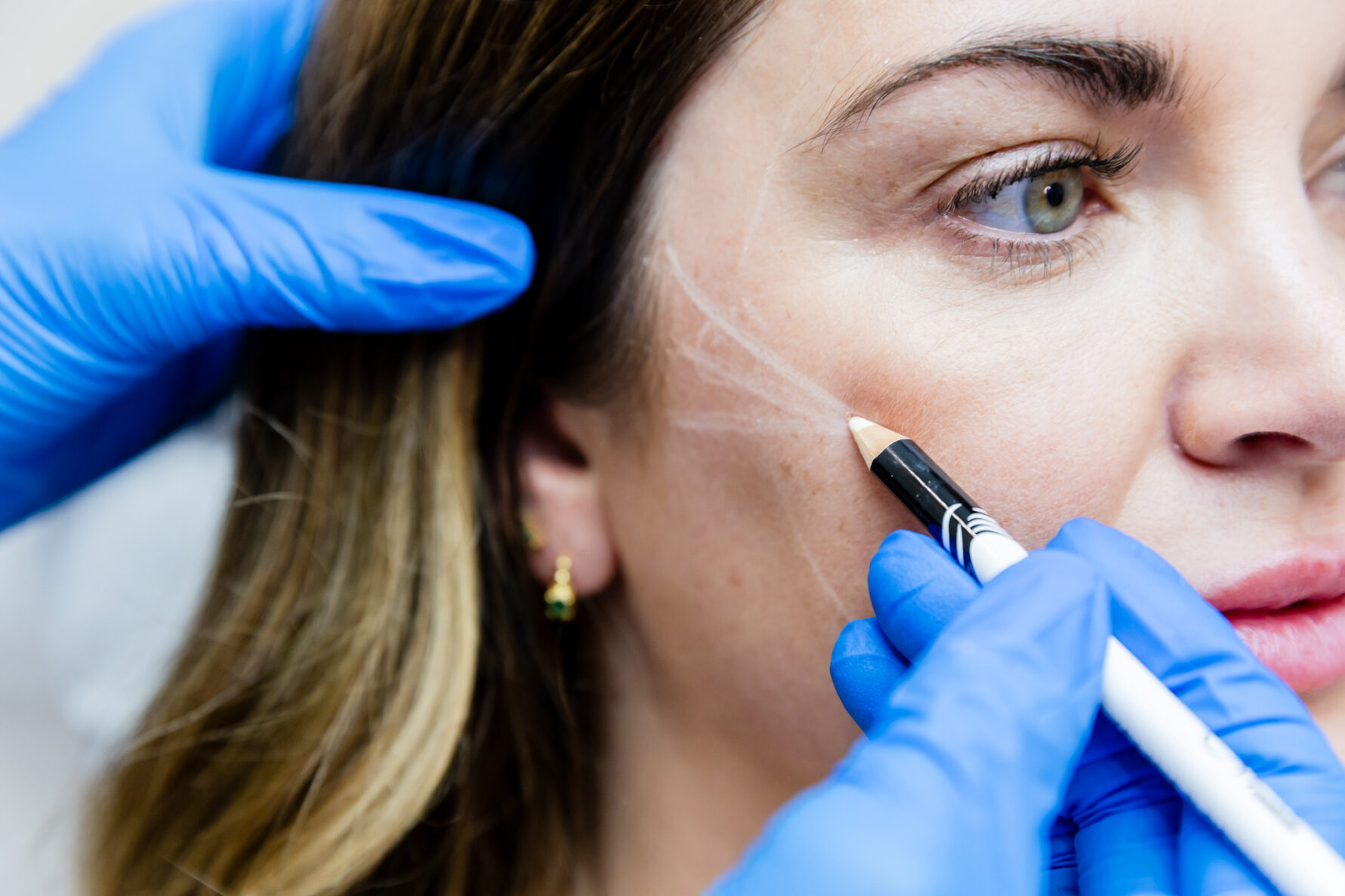 Dermal Fillers in Winchester | Blossom Medical