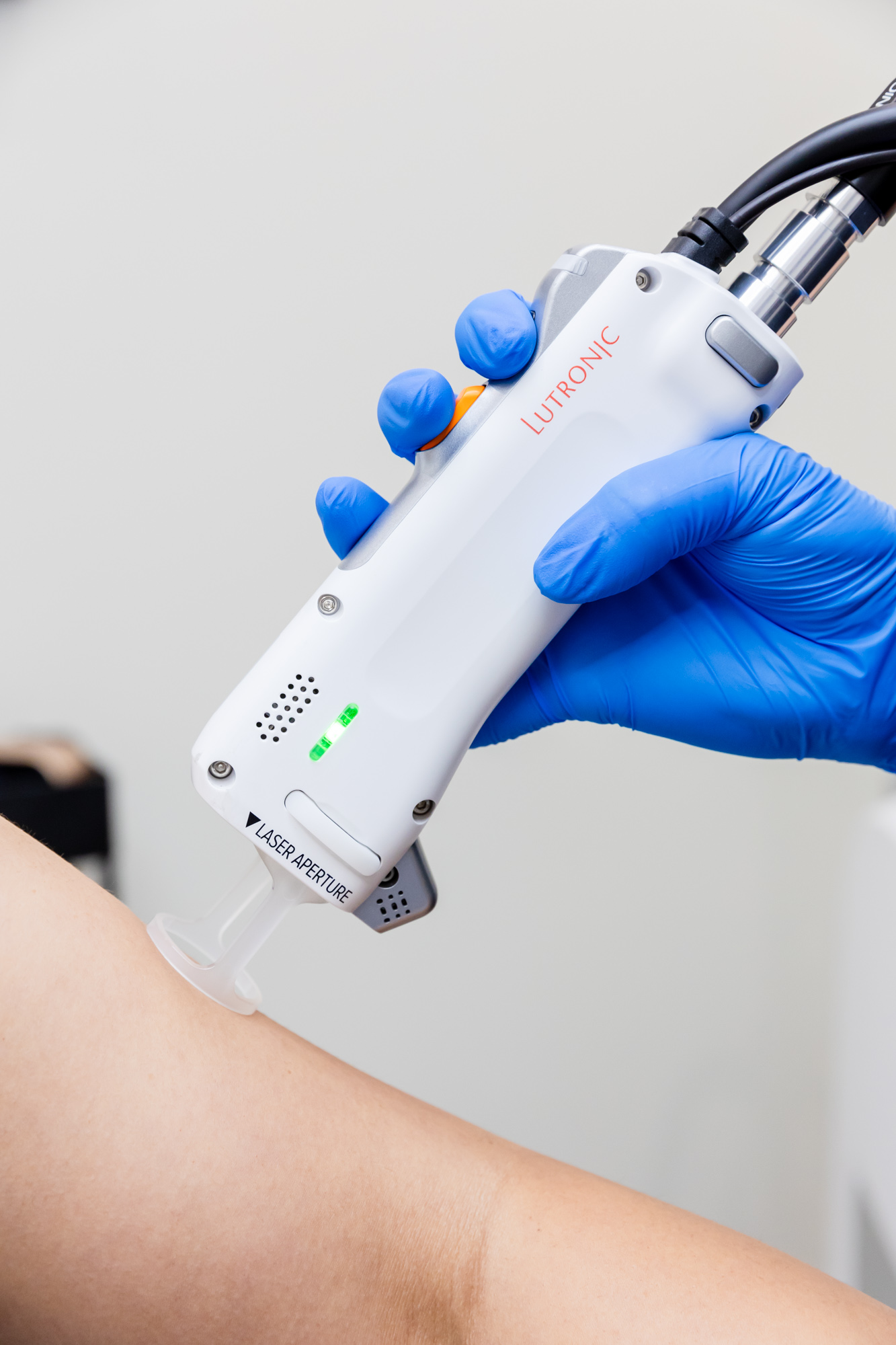 Spider Vein Treatment in Winchester | Blossom Medical