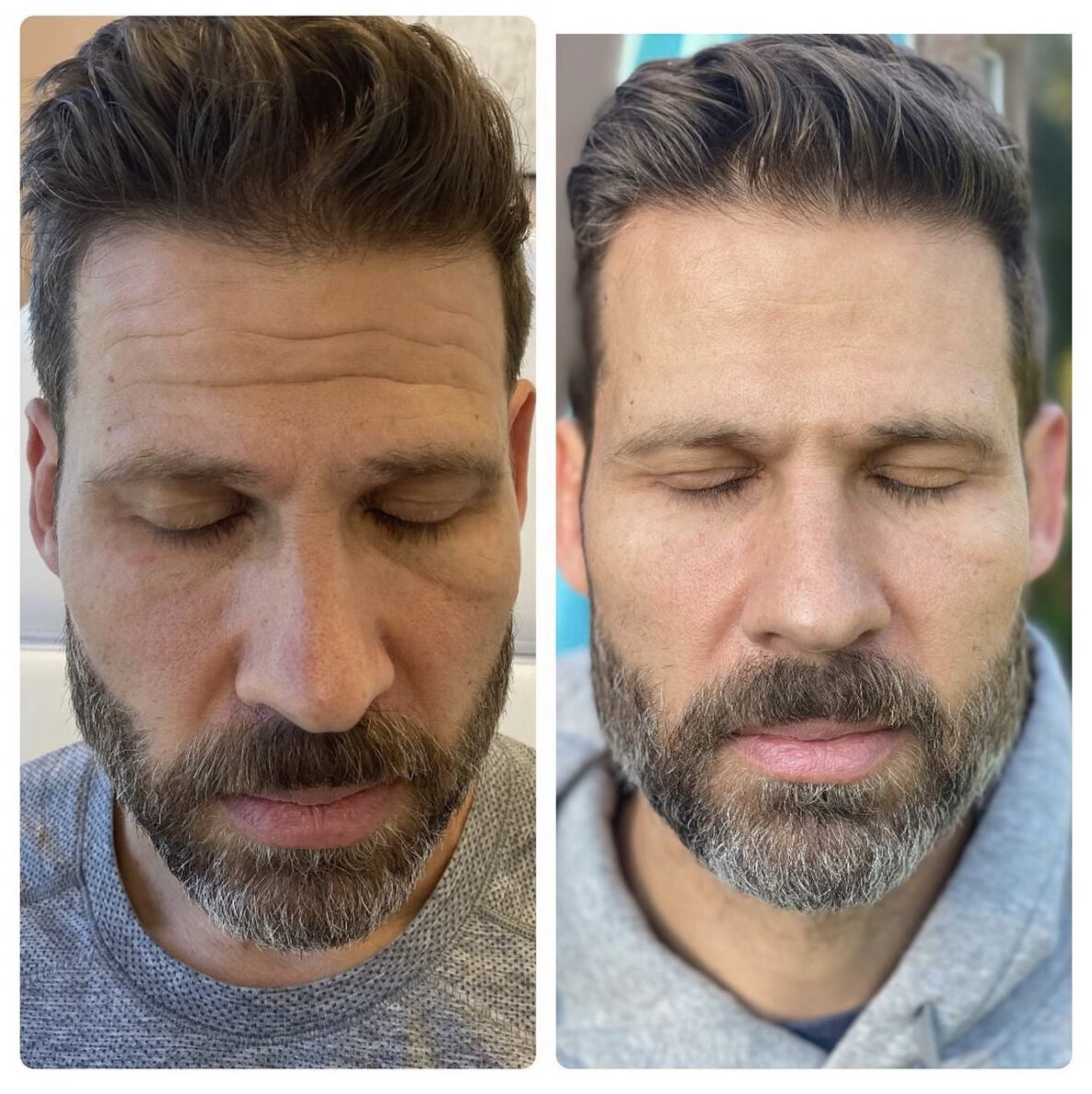 Botox 2 - Blossom Medical