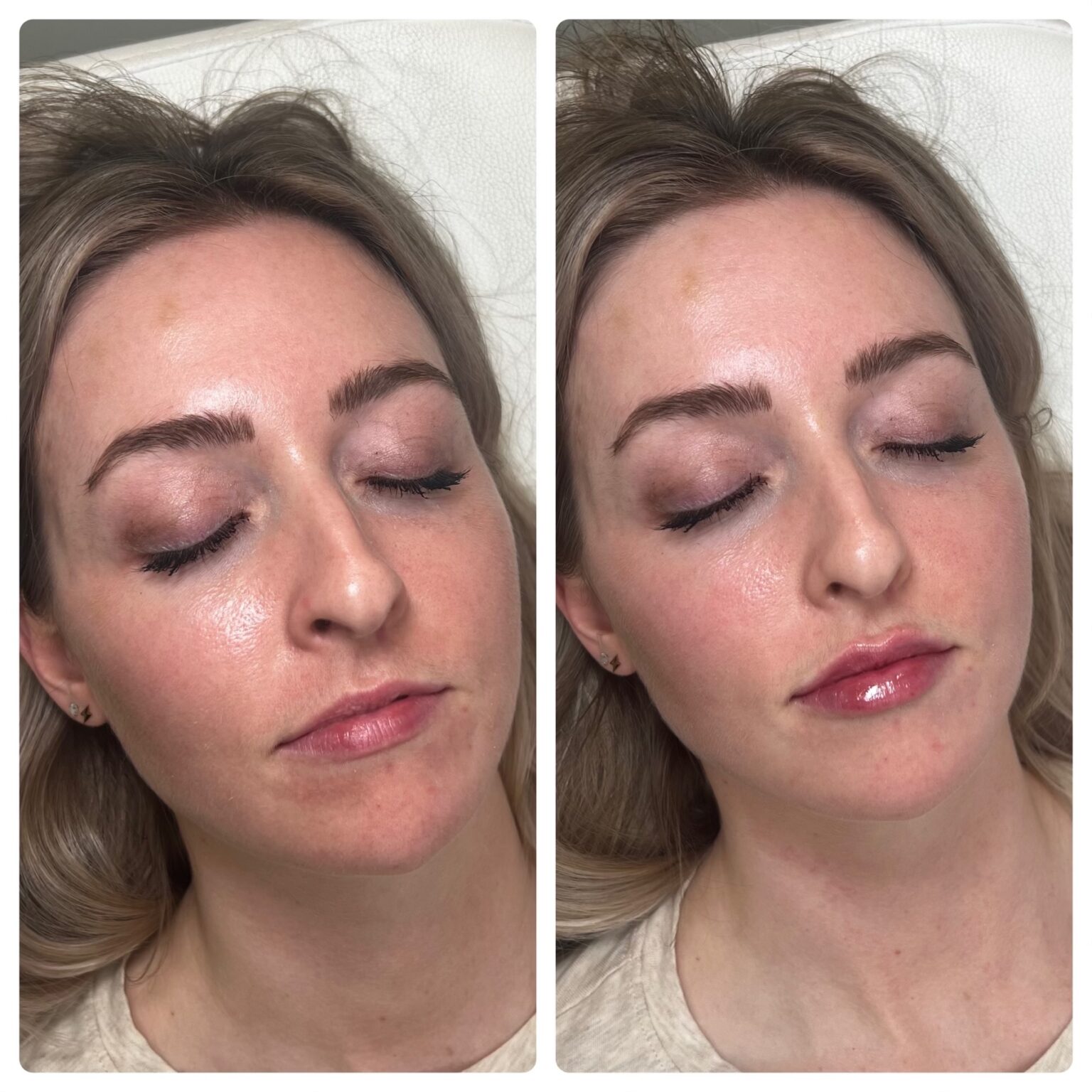 Dermal Fillers in Winchester | Blossom Medical