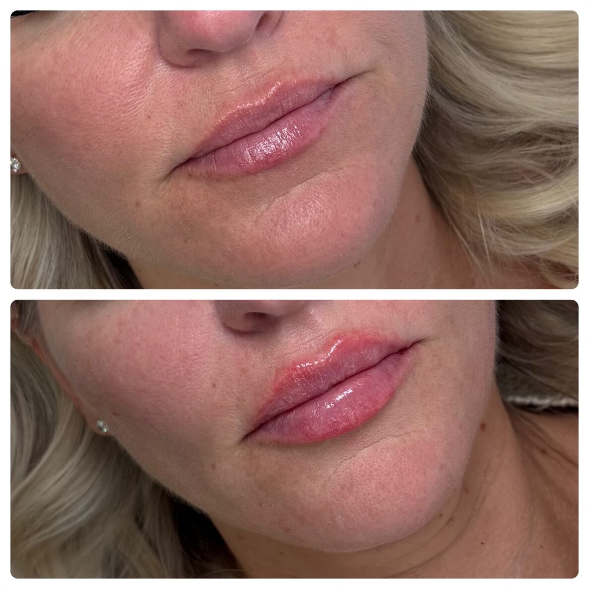 Dermal Fillers in Winchester | Blossom Medical