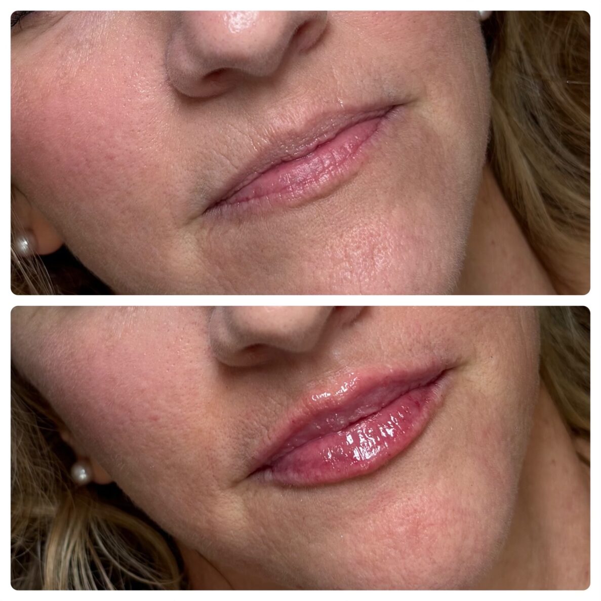 Dermal Fillers in Winchester | Blossom Medical