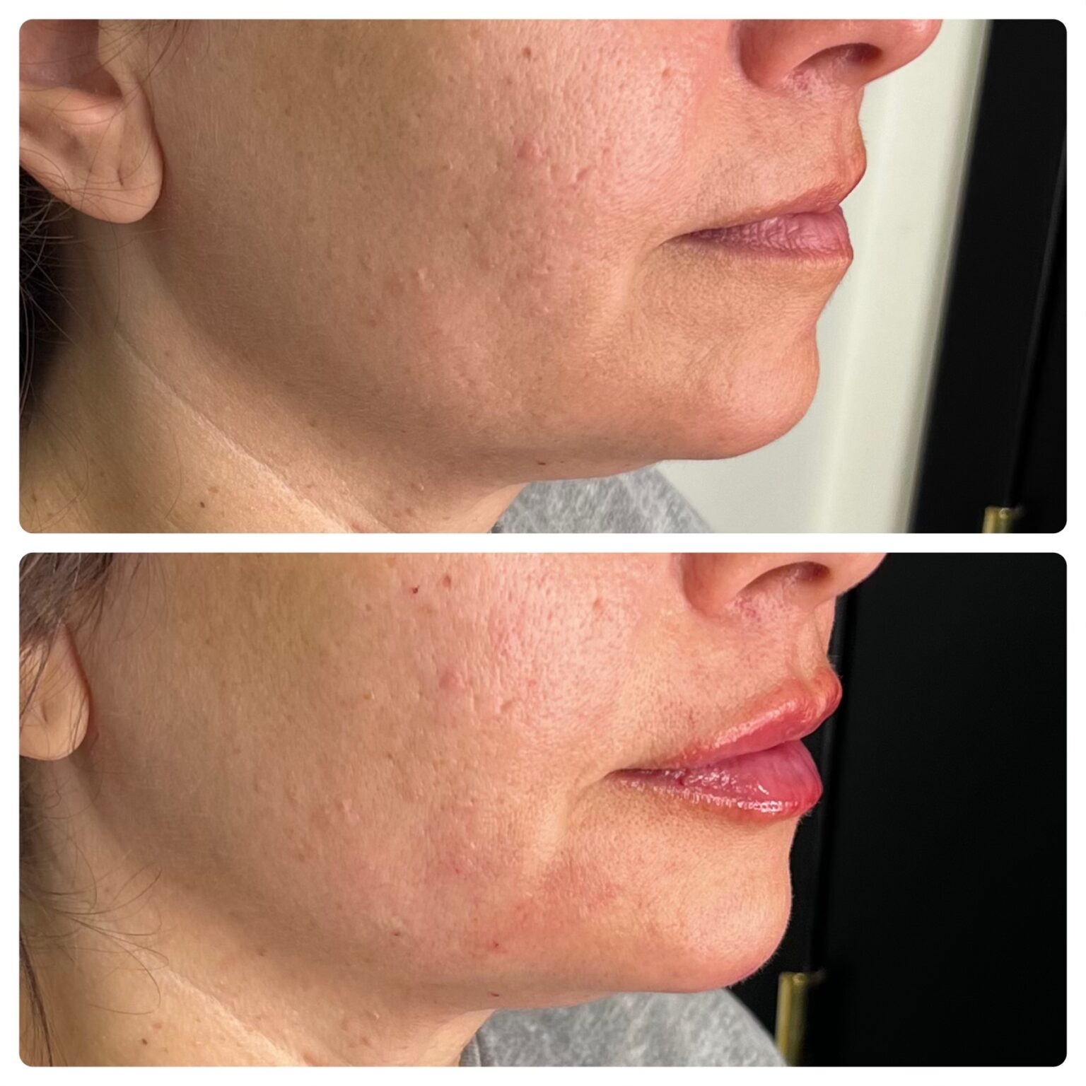 Dermal Fillers in Winchester | Blossom Medical