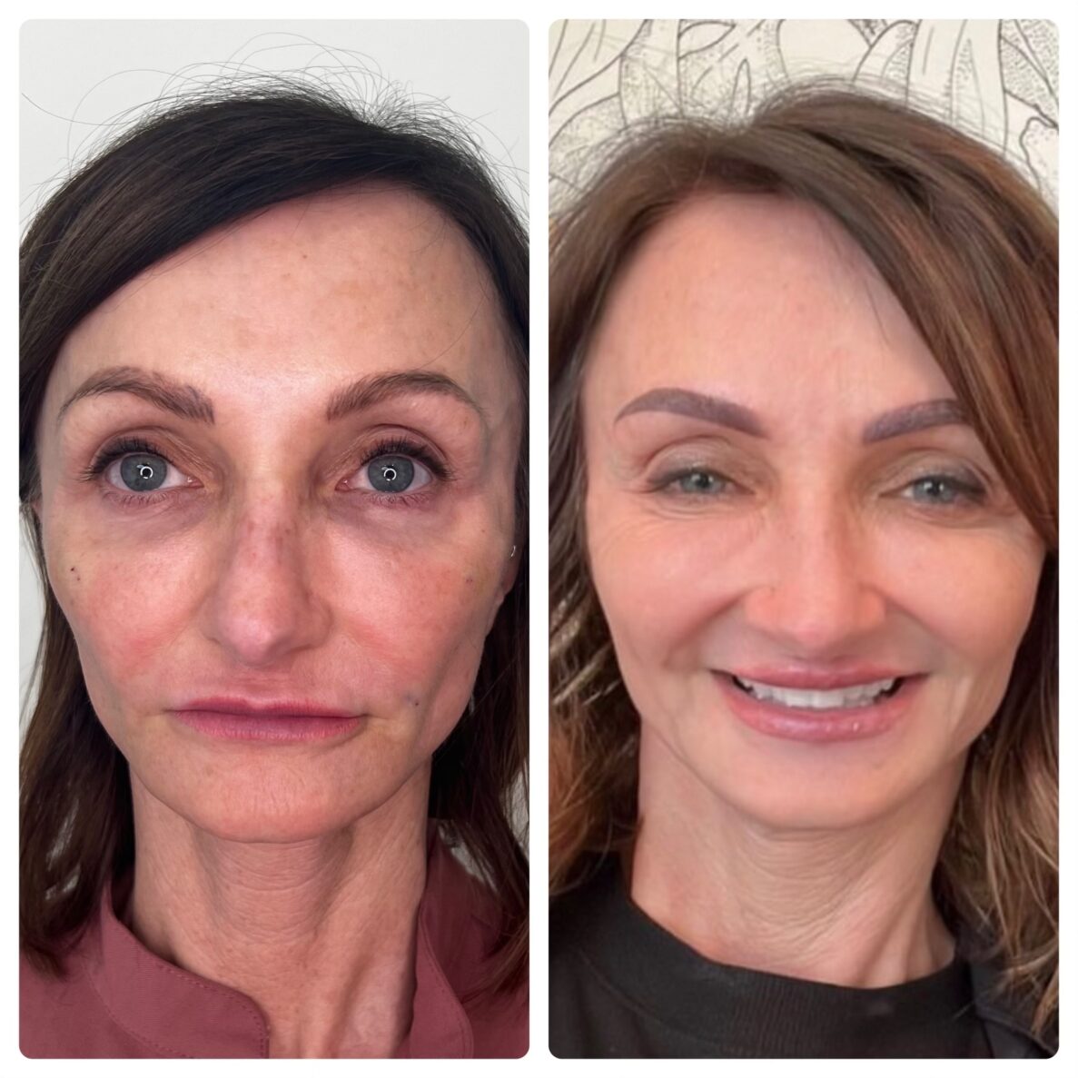 Sculptra 2 plus PRF - Blossom Medical