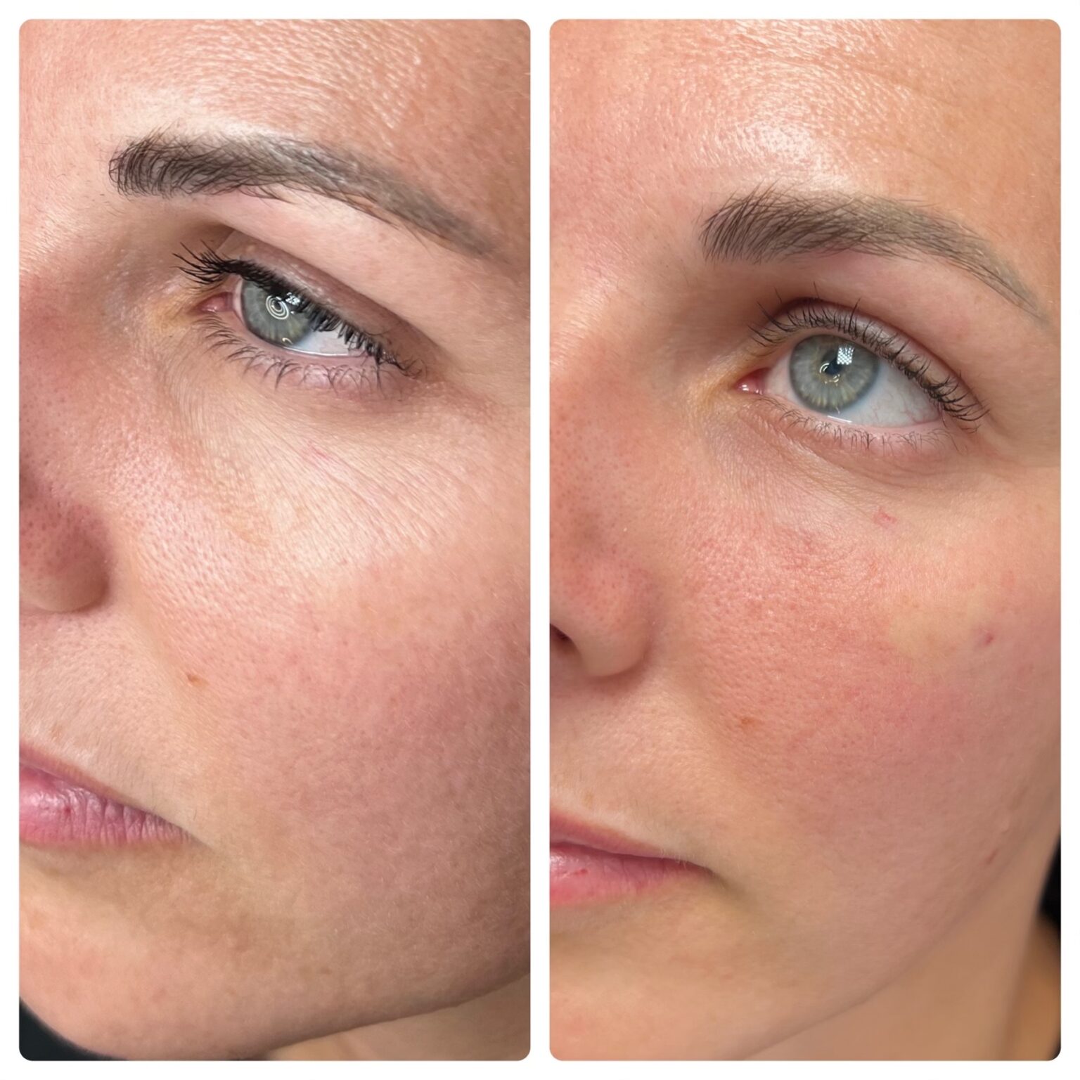 Dermal Fillers in Winchester | Blossom Medical