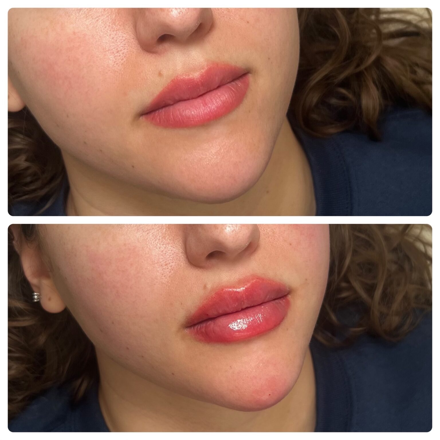 Dermal Fillers in Winchester | Blossom Medical