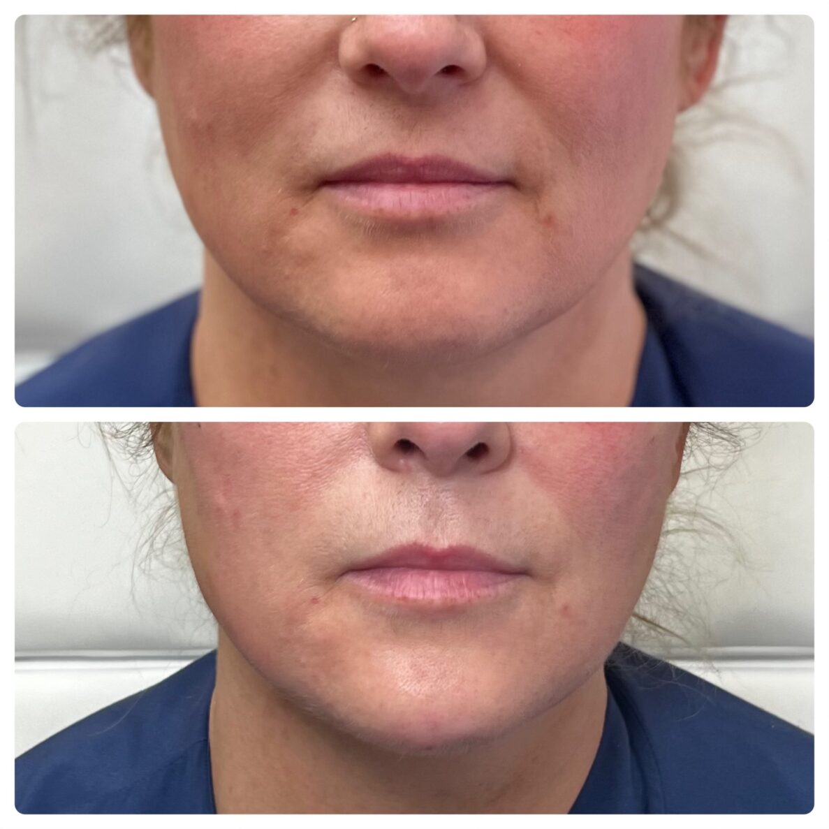 Dermal Fillers in Winchester | Blossom Medical